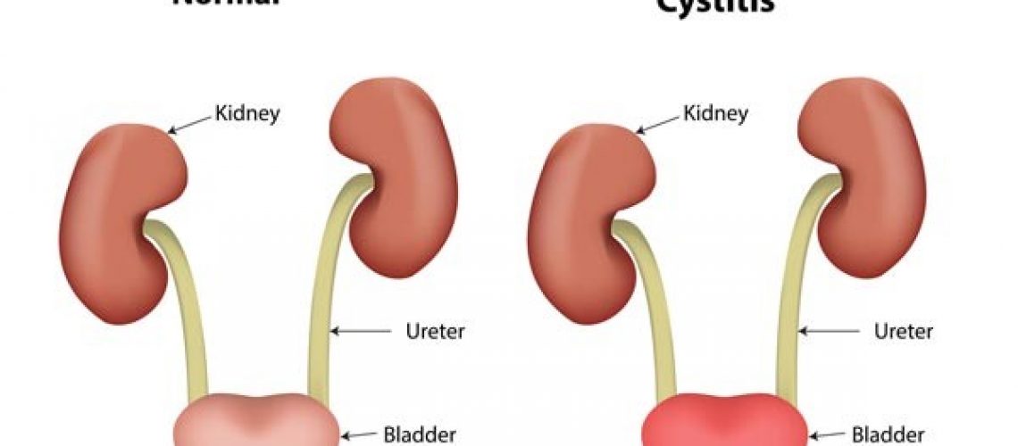¿Qué es la cistitis intersticial? - Urology Center
